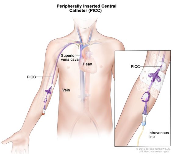 Definition Of PICC NCI Dictionary Of Cancer Terms NCI