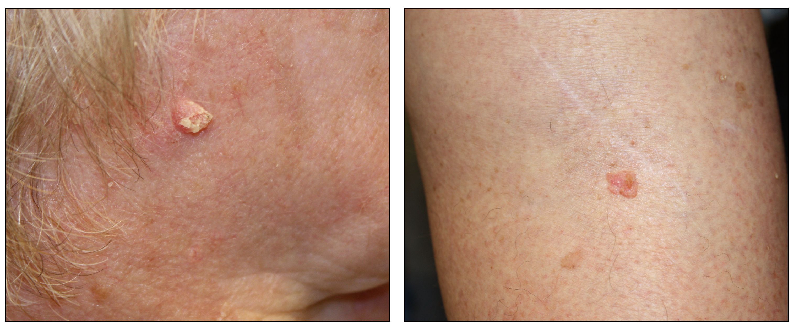 Start Of Skin Cancer On Face Start Of Skin Cancer On Face