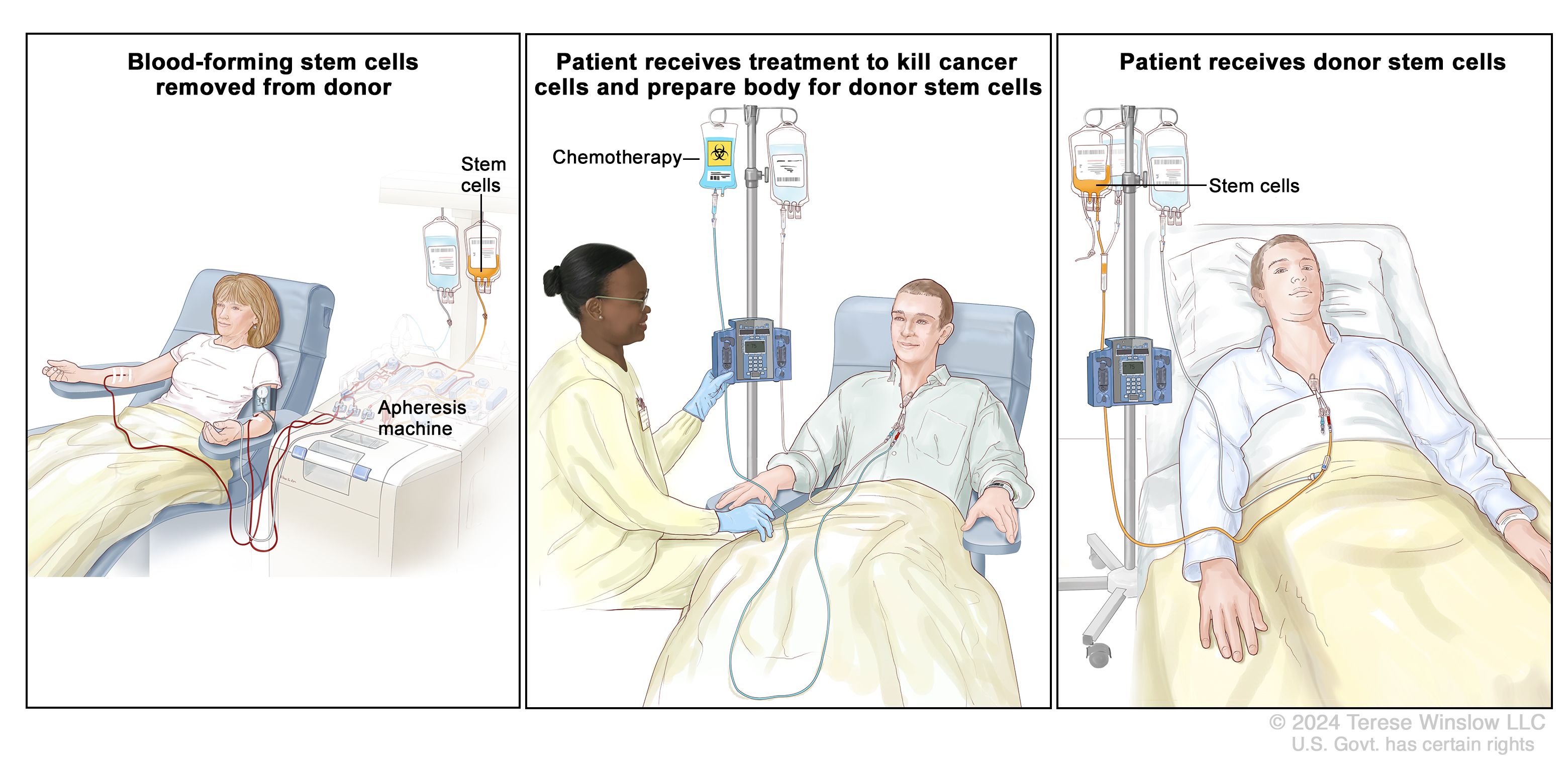 Definition Of Allogeneic Stem Cell Transplant NCI Dictionary Of