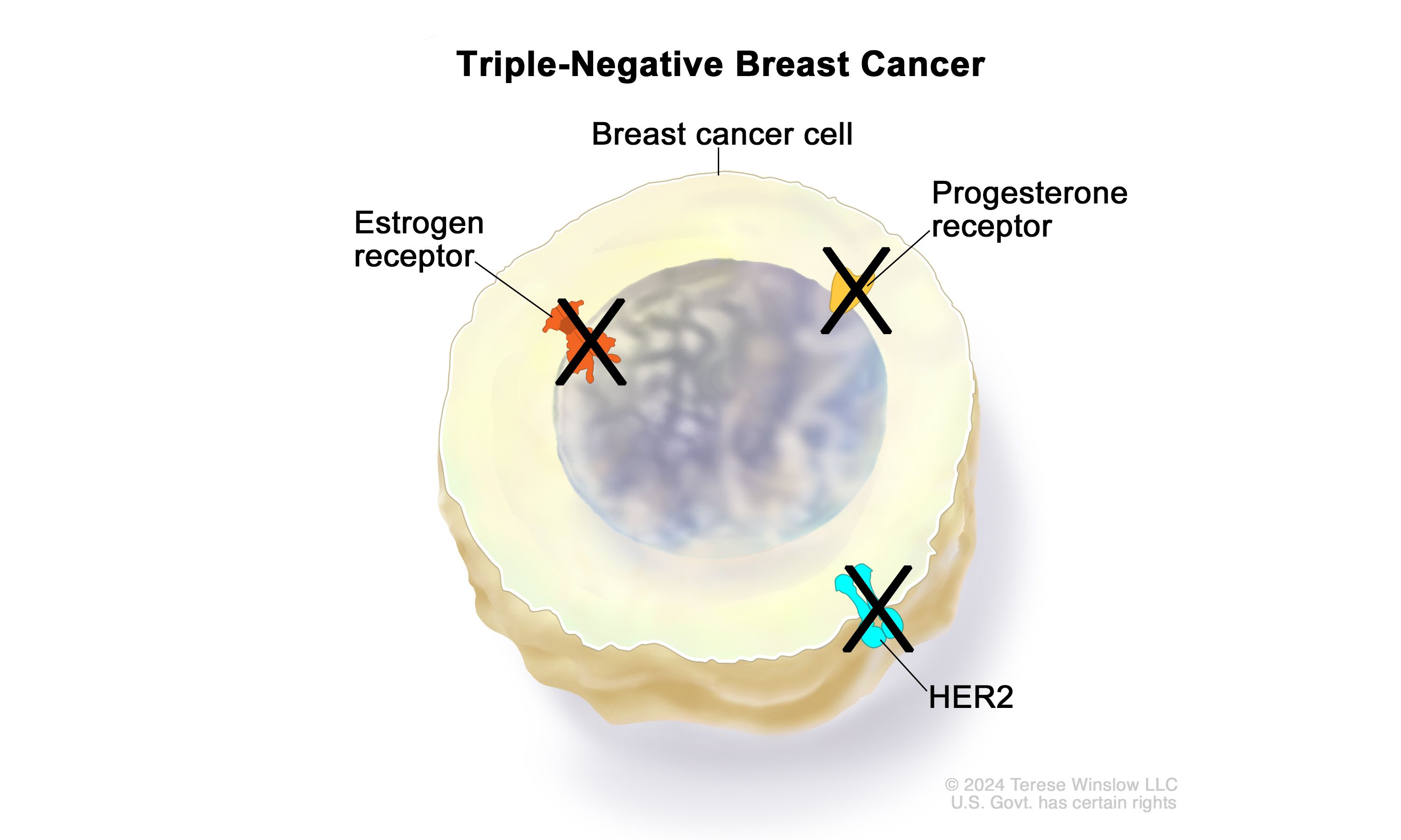 Definition Of Triple Negative Breast Cancer Nci Dictionary Of Cancer